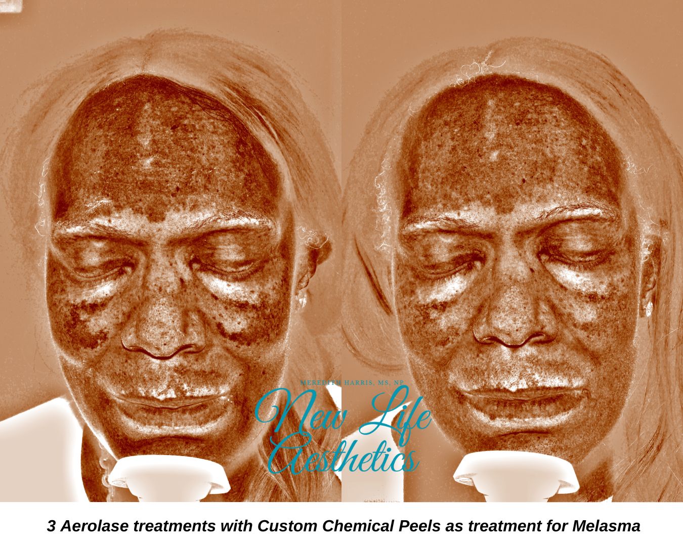 Aerolase LightPod Neo Raleigh NC | New Life Aesthetics