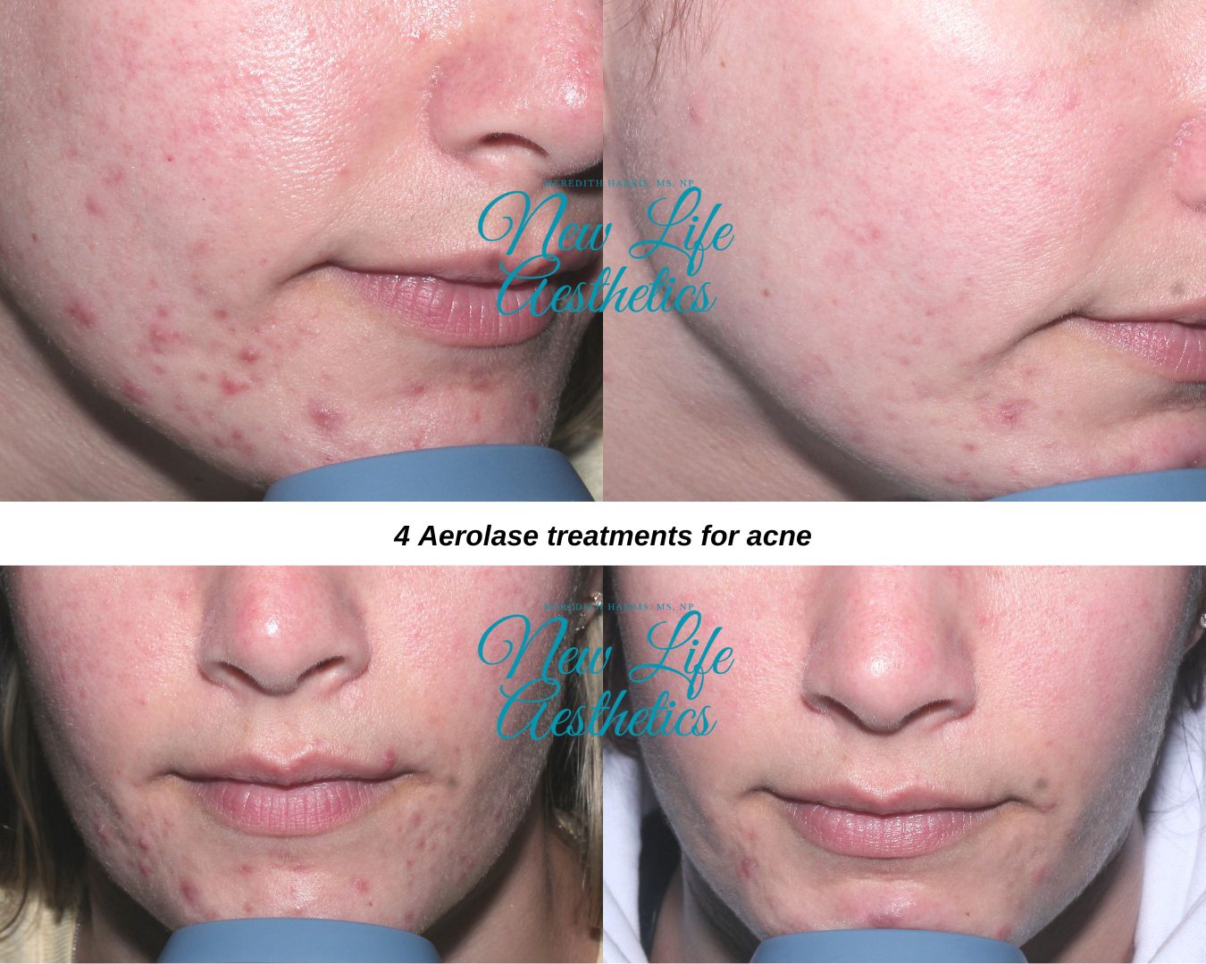 Aerolase LightPod Neo Raleigh NC | New Life Aesthetics