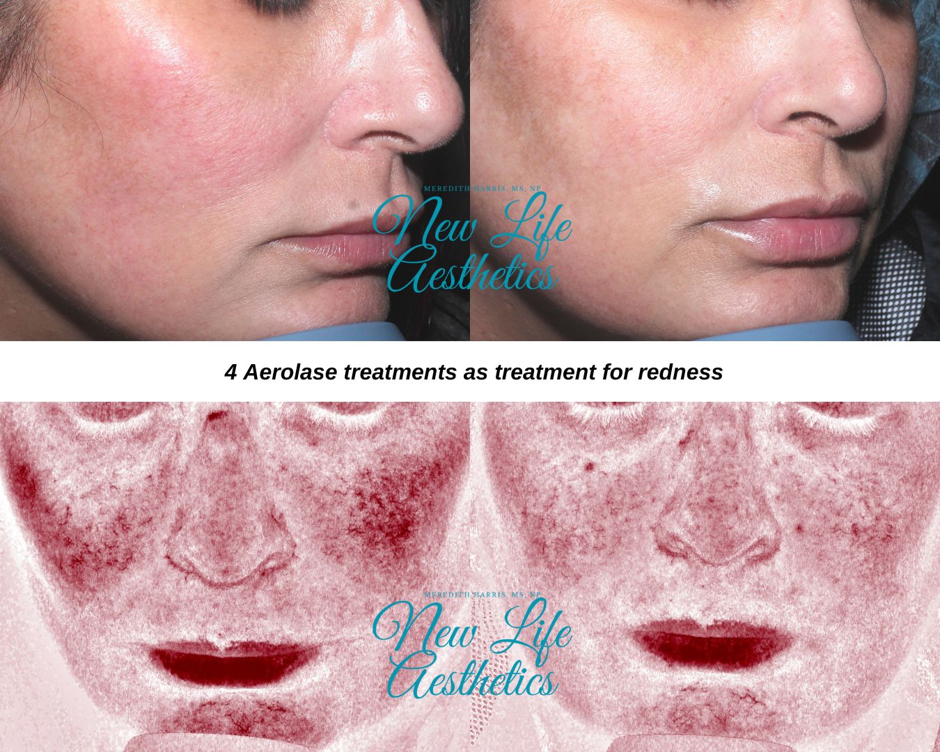 Aerolase LightPod Neo Raleigh NC | New Life Aesthetics