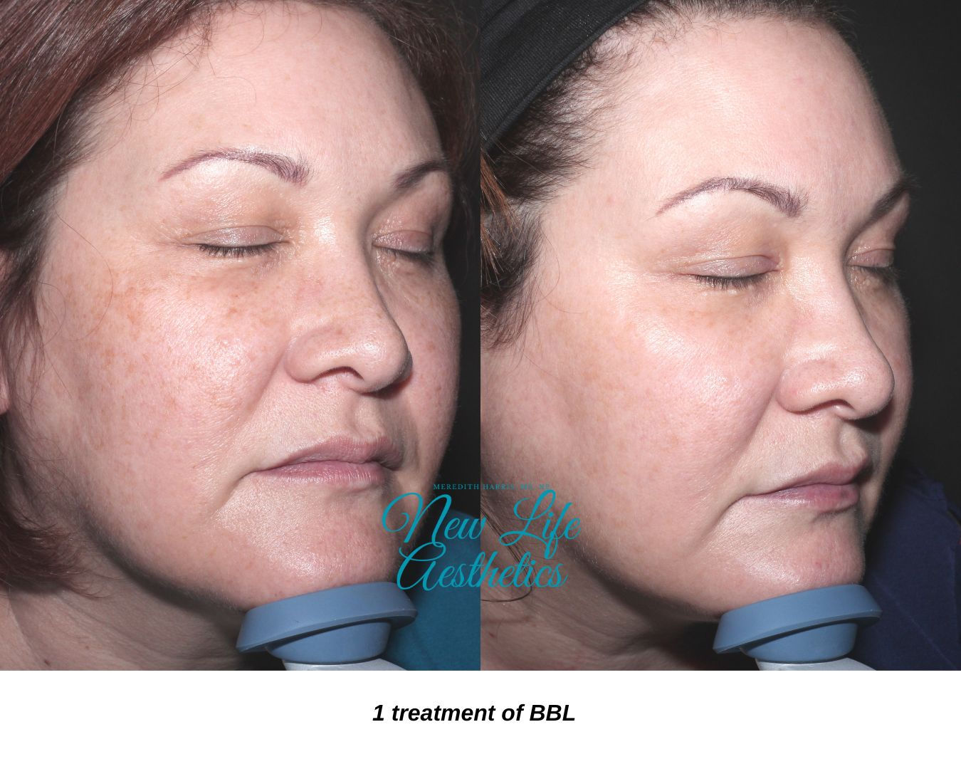 Forever Young BBL Therapy Raleigh NC | Skin Therapy