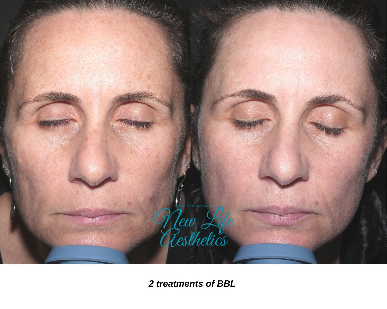 Forever Young BBL Therapy Raleigh NC | Skin Therapy