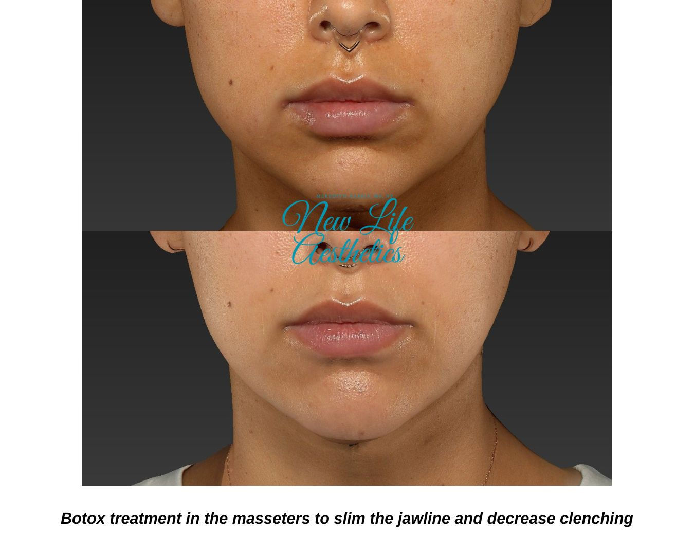 Botox Raleigh NC | Botox Cosmetic Injections