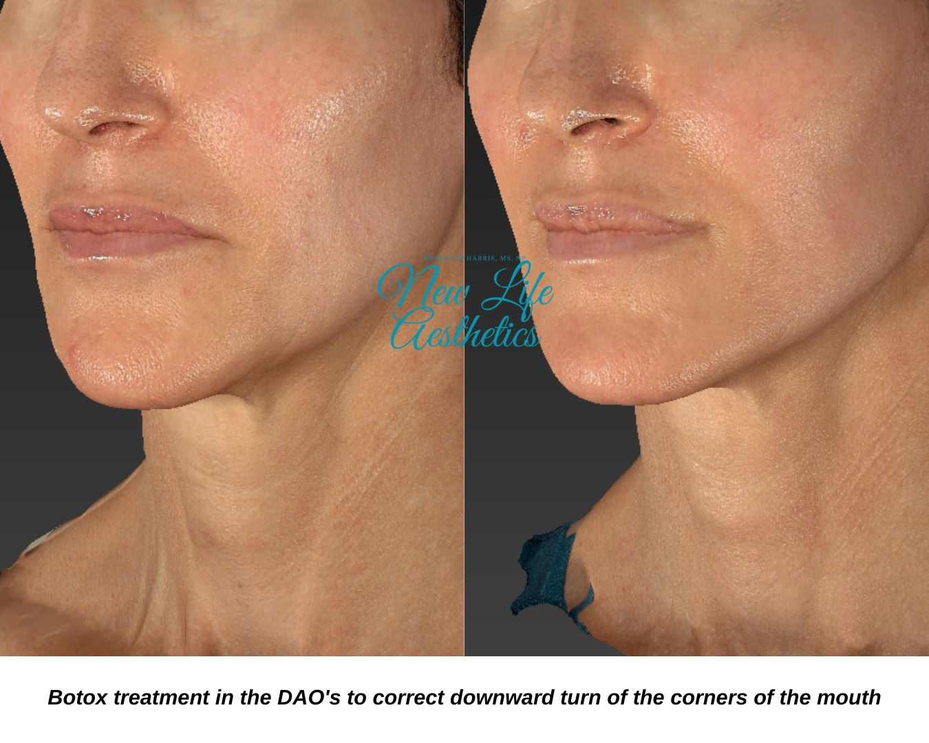 Botox Raleigh NC | Botox Cosmetic Injections