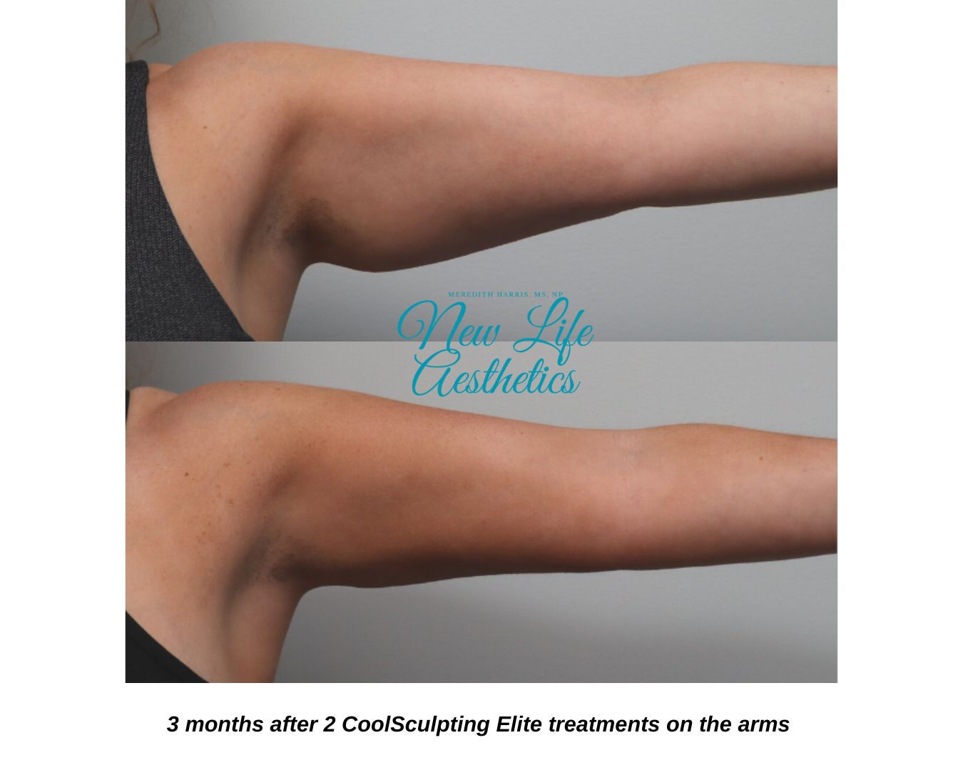 CoolSculpting Elite Raleigh NC | Fat Reduction Treatment