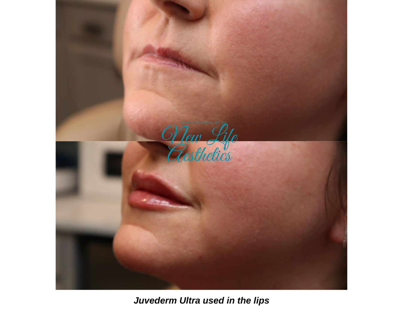 Dermal Fillers Raleigh | Juvederm Volbella, Vollure, Voluma, Volux