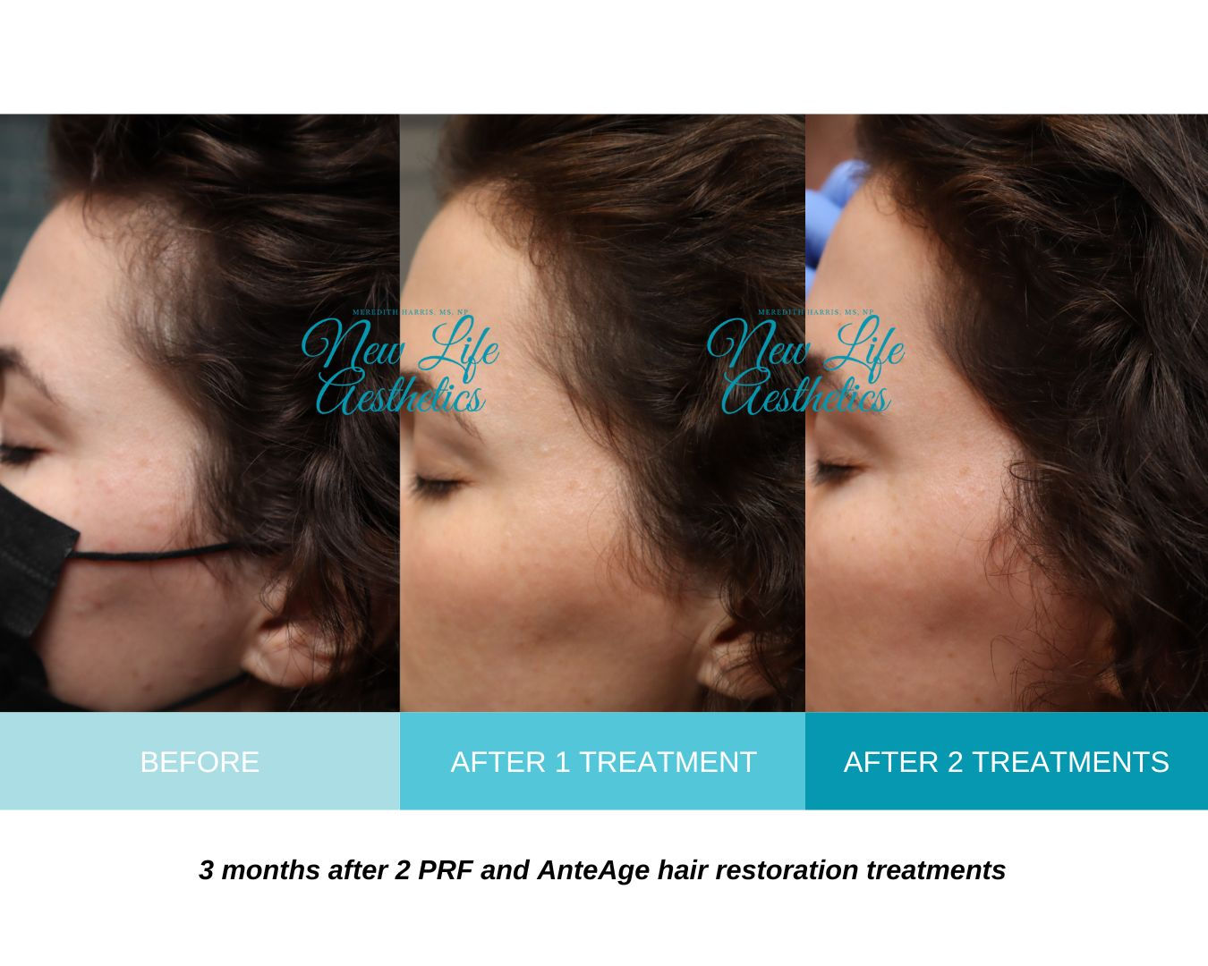 Hair Restoration Clinic Raleigh NC | Platelet Rich Fibrin Therapy