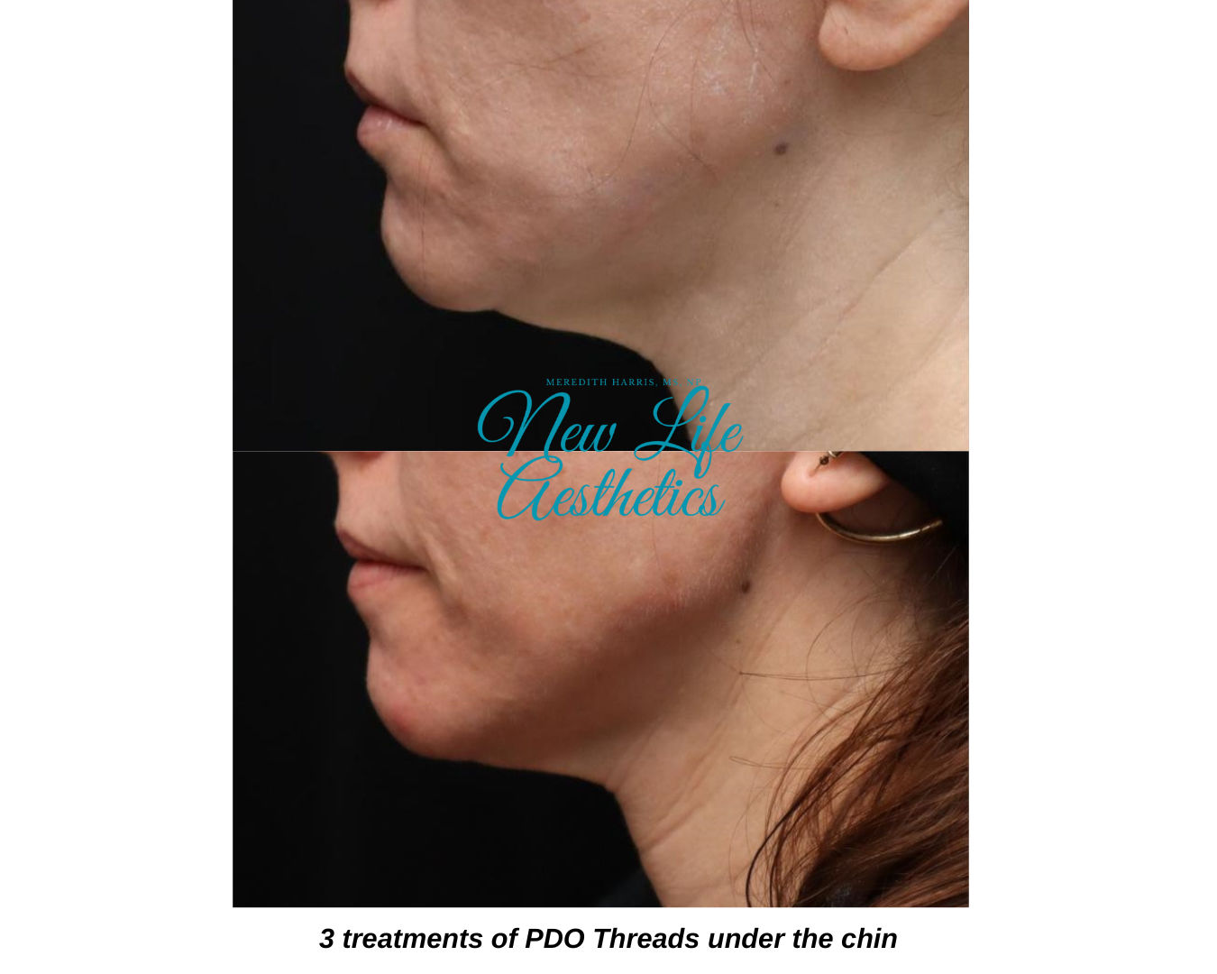 PDO Thread Raleigh NC | New Life Aesthetics