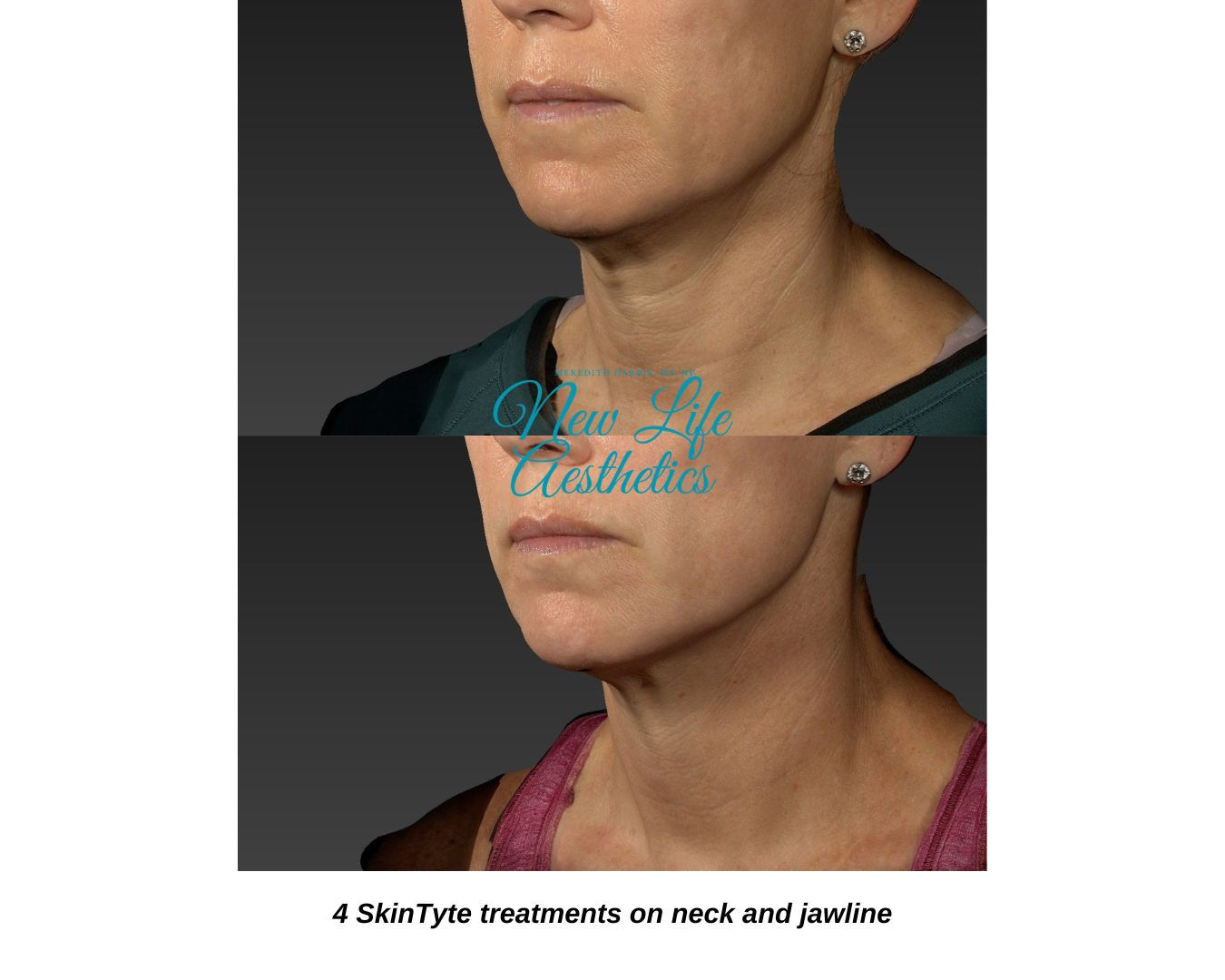 SkinTyte Raleigh NC | BBL Skin Tightening