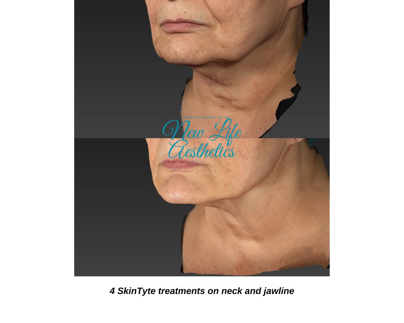 SkinTyte Raleigh NC | BBL Skin Tightening