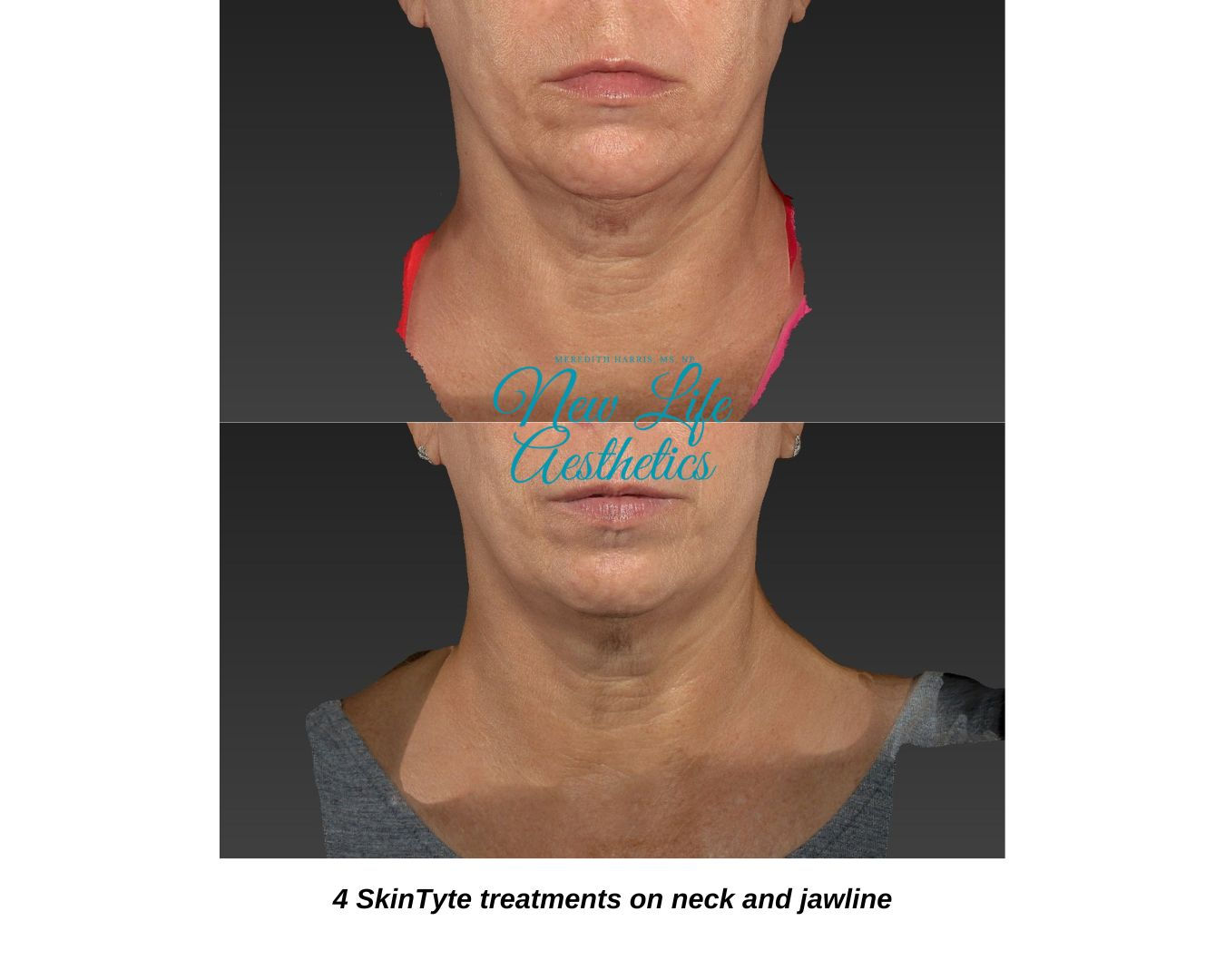 SkinTyte Raleigh NC | BBL Skin Tightening