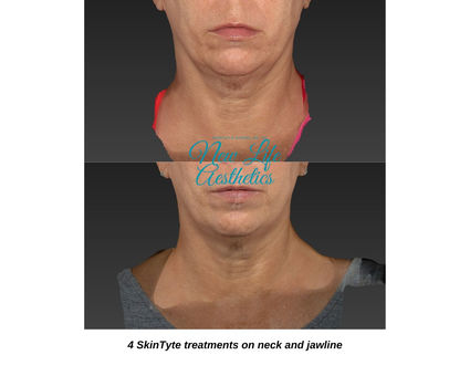 SkinTyte Raleigh NC | BBL Skin Tightening