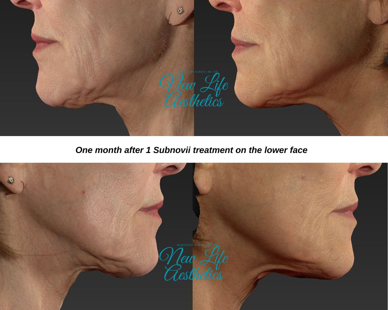 Plasma Pen Raleigh NC | Fibroblast Plasma Pen Treatment