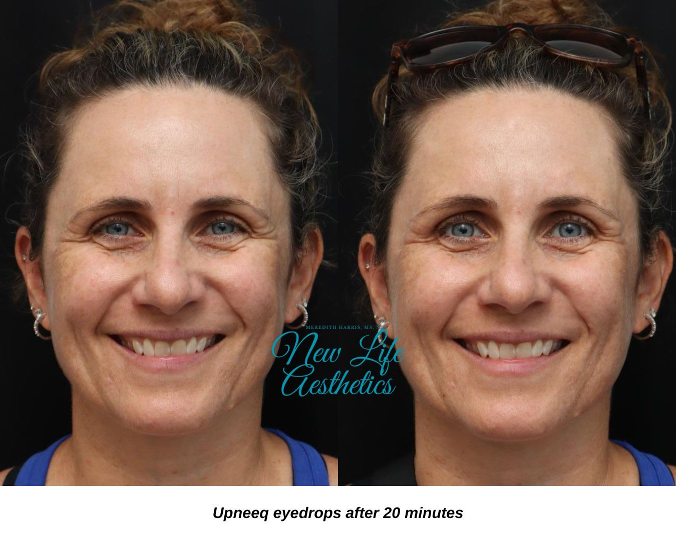 Upneeq Prescription Eyedrop Raleigh NC | New Life Aesthetics