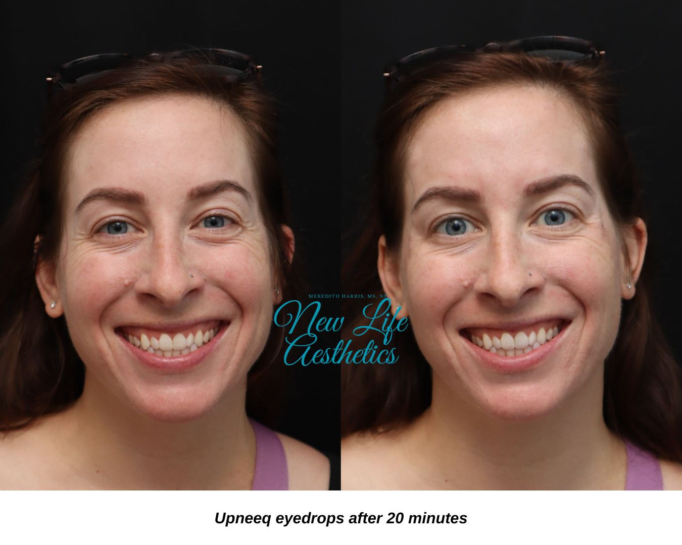 Upneeq Prescription Eyedrop Raleigh NC | New Life Aesthetics