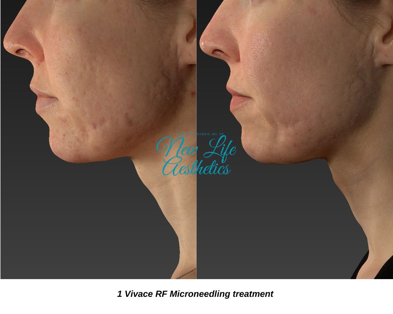 RF Microneedling Raleigh NC | Vivace Ultra