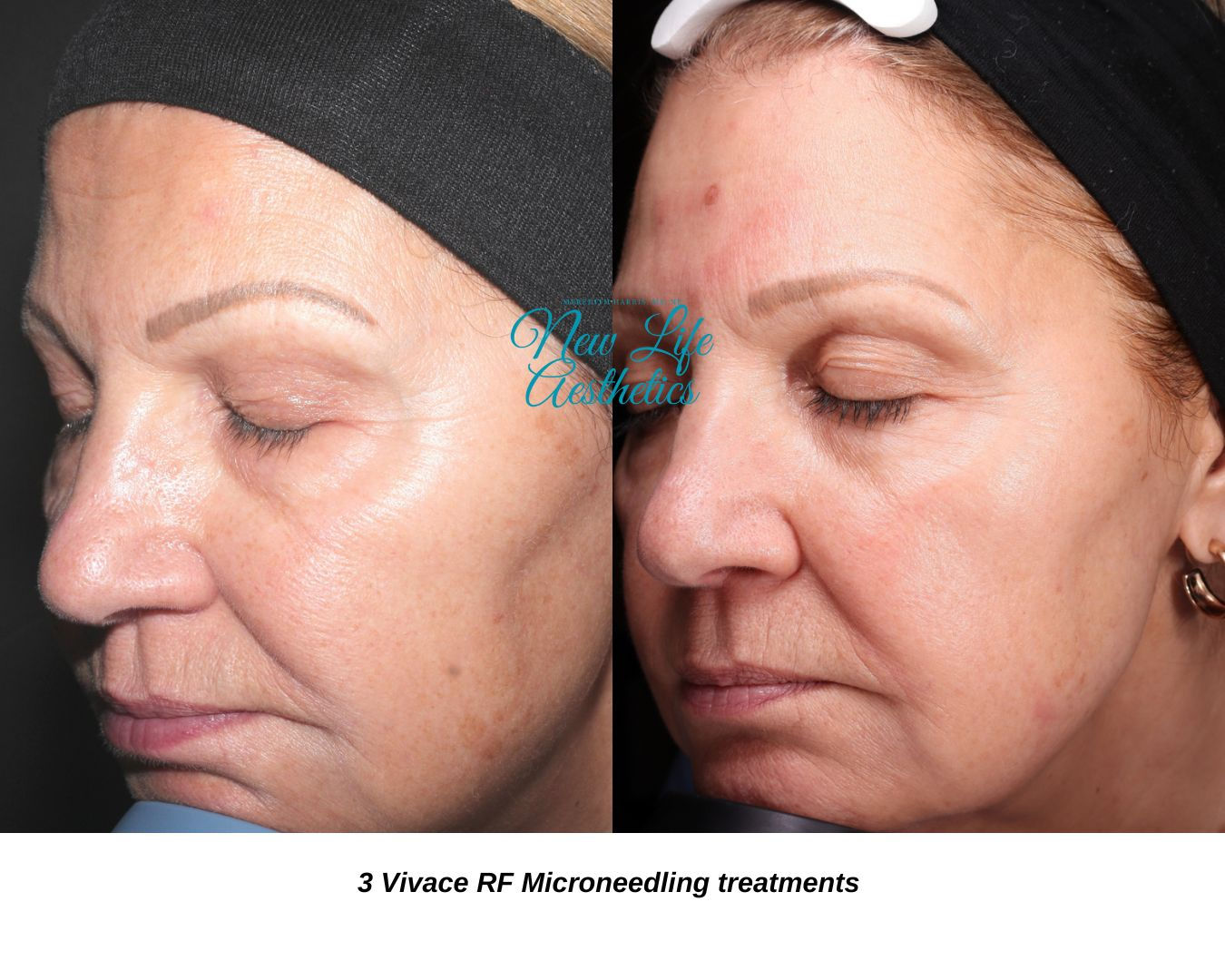 RF Microneedling Raleigh NC | Vivace Ultra