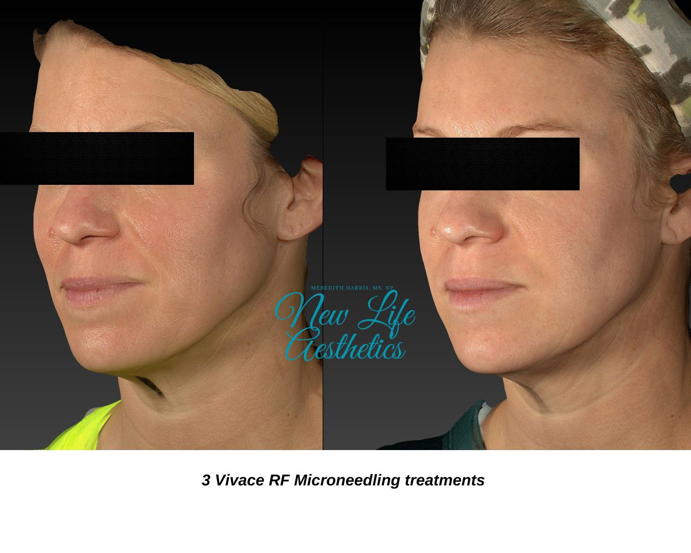 RF Microneedling Raleigh NC | Vivace Ultra